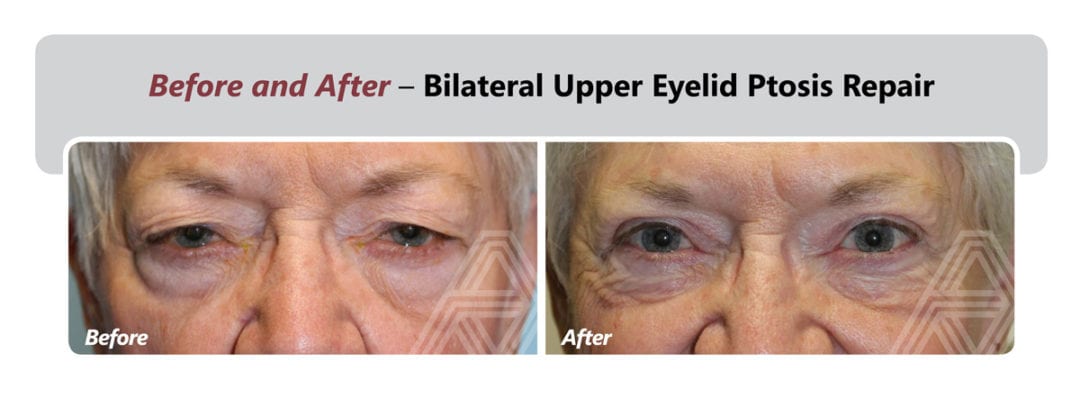 Eyelid Ptosis Repair | Triad Eye Institute